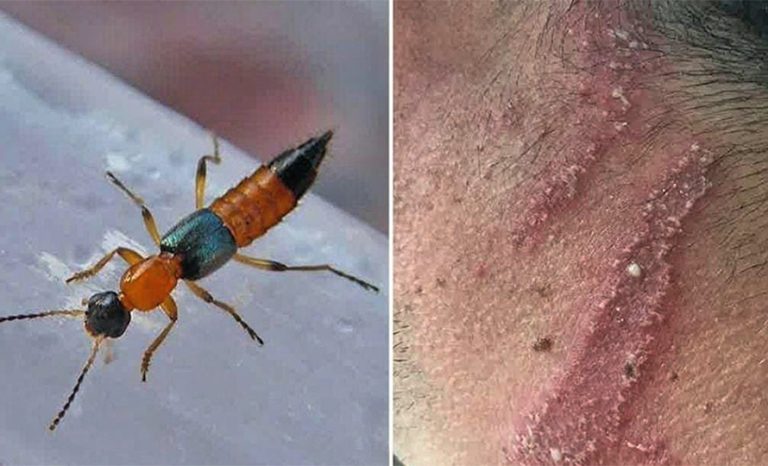 Nairobi fly in Nepal: Know about growing cases in 2022