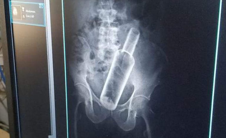 Dhangadhi hospital finds liquor bottle in 61-year-old's body in X-ray ...